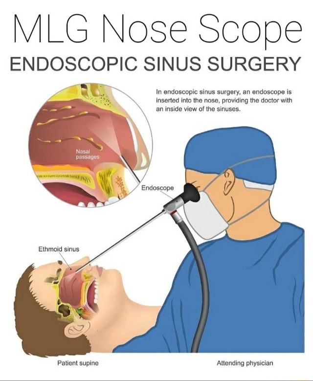 MLG Nose Scope ENDOSCOPIC SINUS SURGERY In endoscopic sinus surgery, an ...