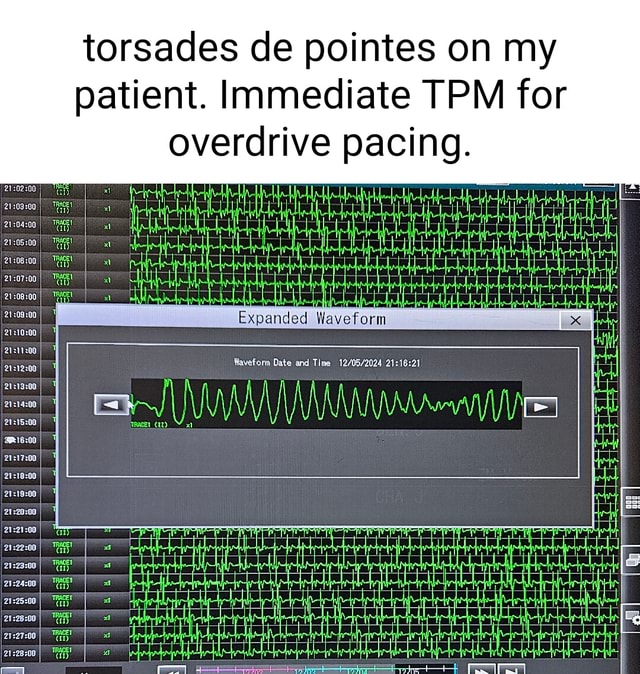 Torsades de pointes on my patient. Immediate TPM for overdrive pacing ...