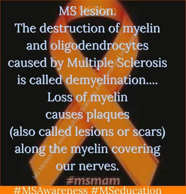 MS lesion. The destruction of myelin and oligodendrocytes caused by ...
