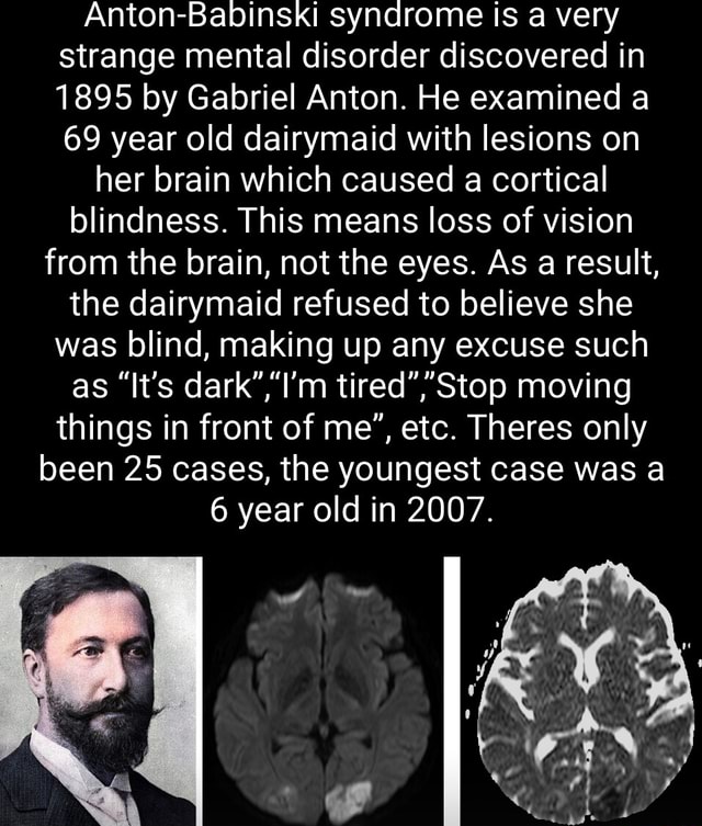 Anton-Babinski syndrome is a very strange mental disorder discovered in ...