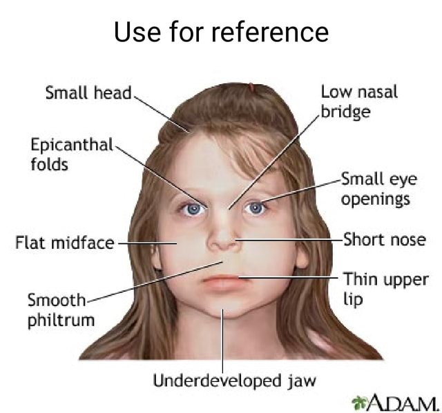 Use for reference Small head Low nasal eye openings Flat midface Short ...