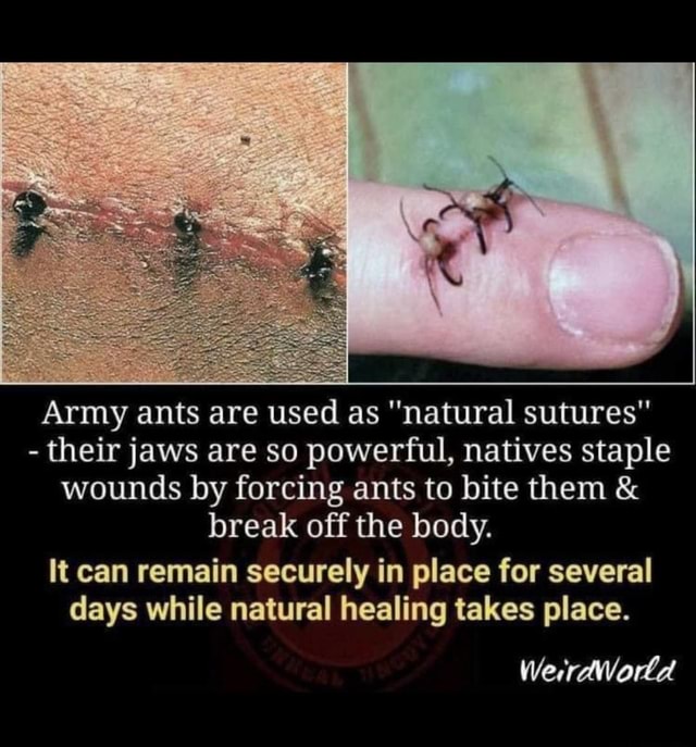 Army ants are used as "natural sutures" - their jaws are so powerful ...