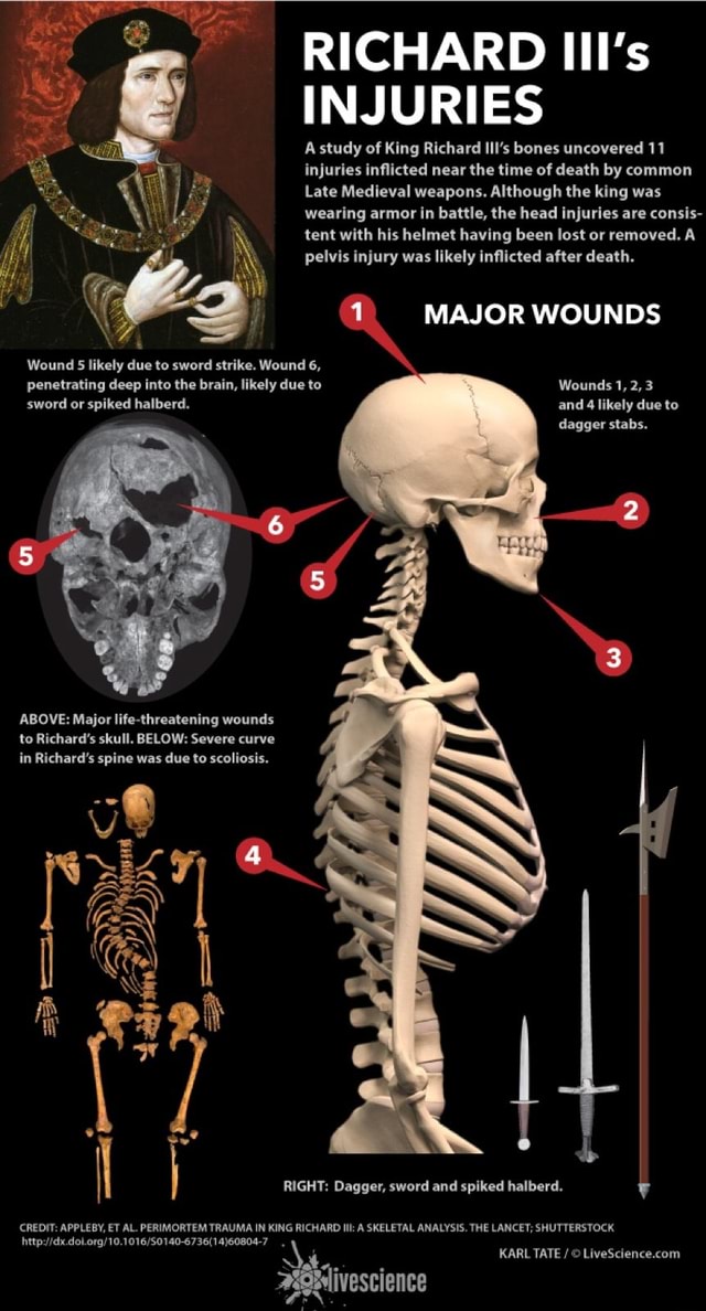 RICHARD III's INJURIES A study of King Richard Ill's bones uncovered 11 ...