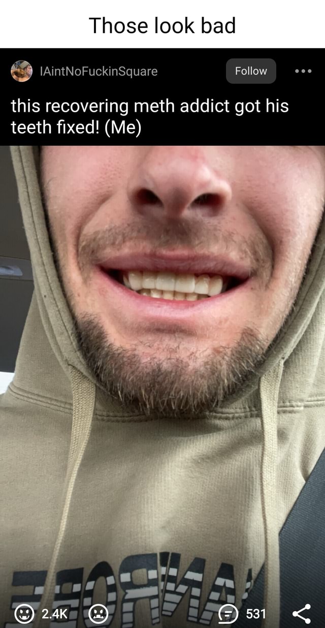 Those look bad IAintNoFuckinSquare this recovering meth addict got his ...