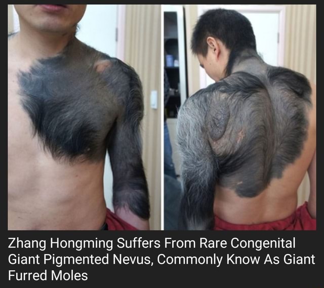 Zhang Hongming Suffers From Rare Congenital Giant Pigmented Nevus ...