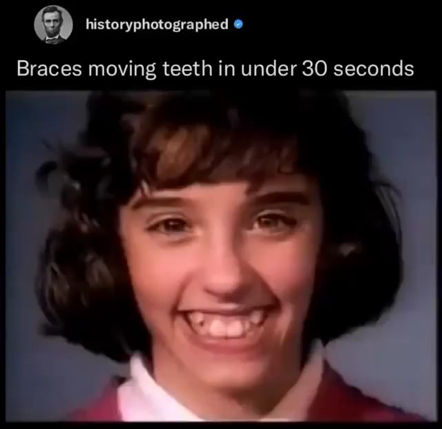 Braces moving teeth in under 30 seconds - iFunny