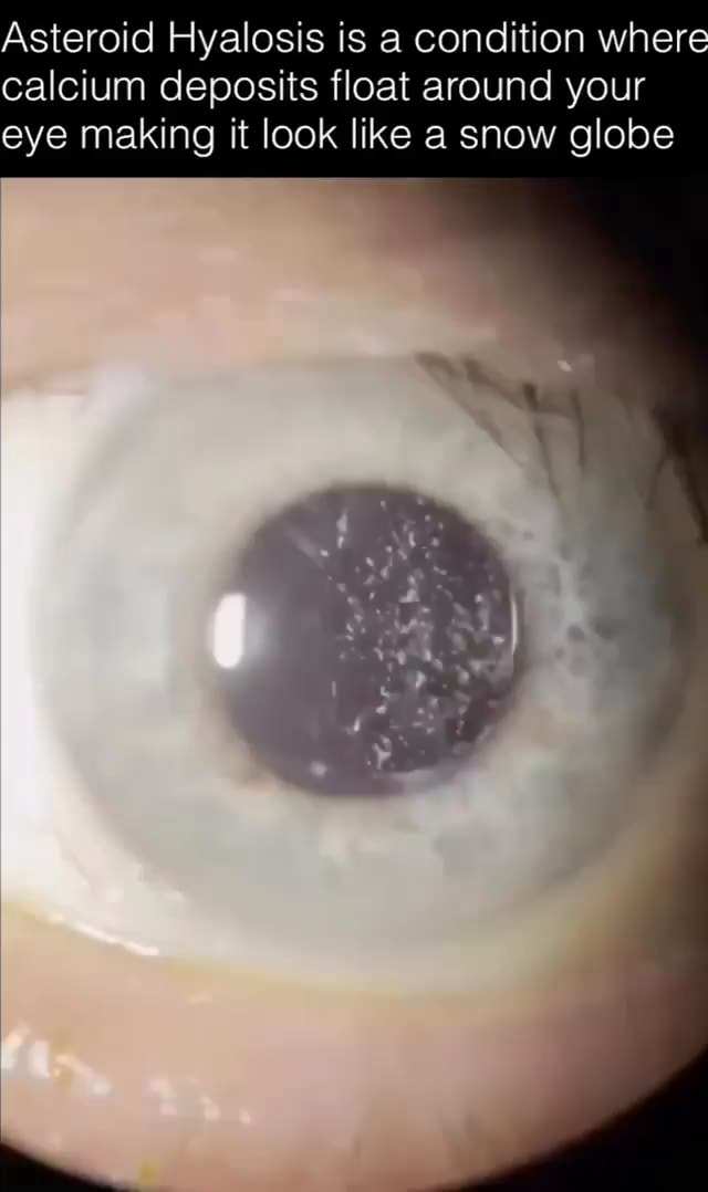 Asteroid Hyalosis is a condition where calcium deposits float around ...