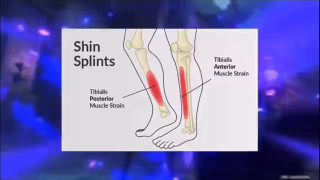 Shin Splints Thialis Posteri Muscle Strain Tibialis Anterior Muscle ...