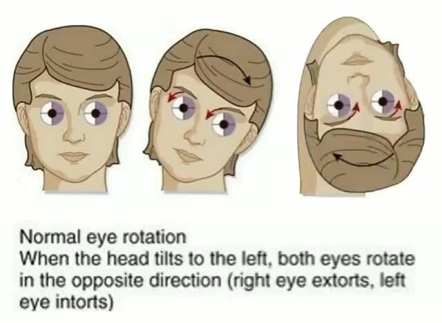 Normal eye rotation When the head tilts to the left, both eyes rotate ...