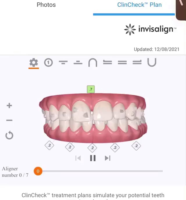 Photos Plan invisalign" Updated: Aligner number - iFunny
