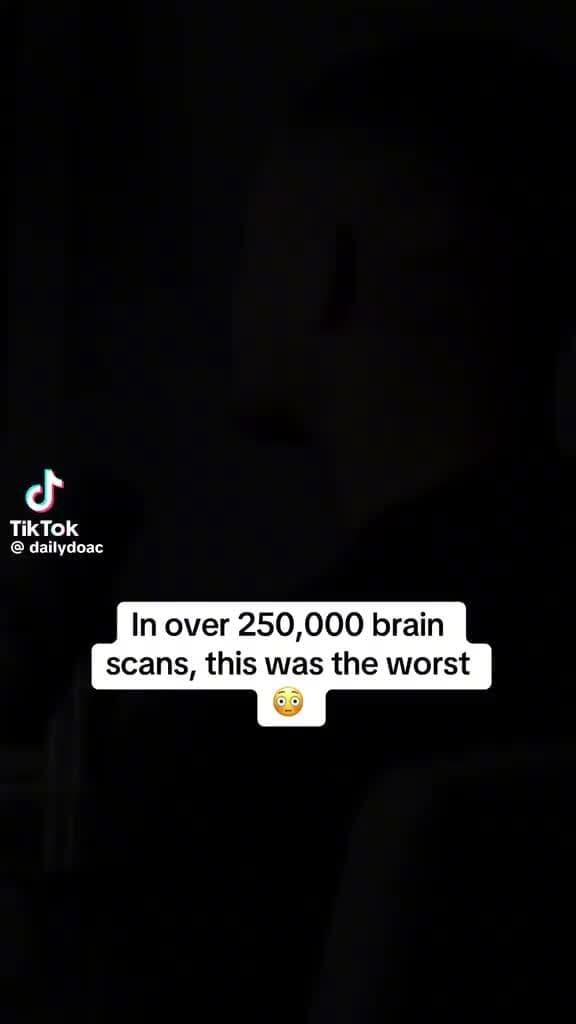 TikTok dailydoac In over 250,000 brain scans, this was the worst - iFunny
