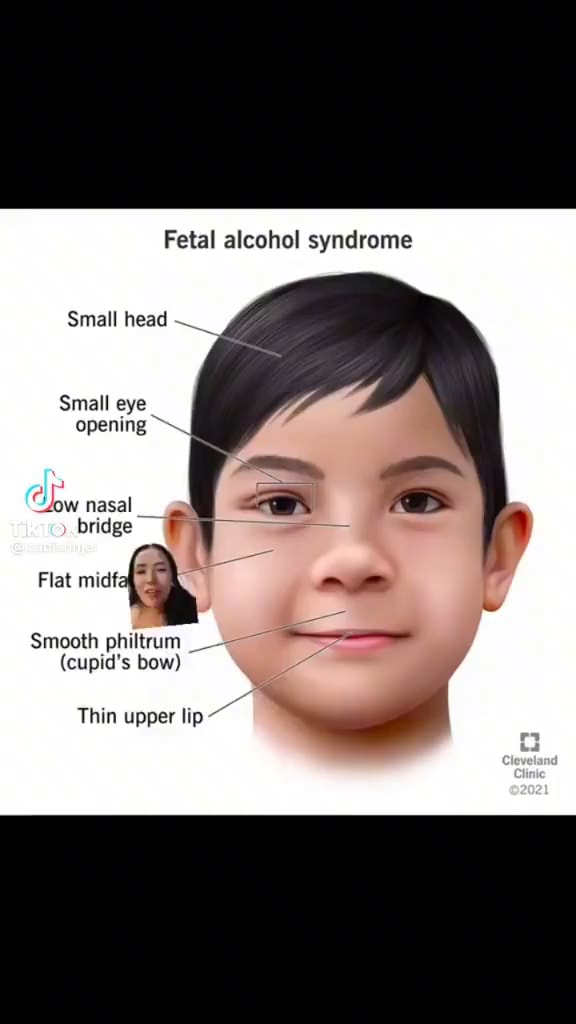 Fetal alcohol syndrome Small head Small eye opening "Jow nasal _ bridge ...